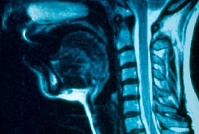 Aparición y tratamiento del cáncer de laringe