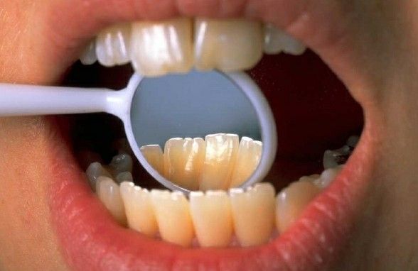 Así cambian los dientes y encías con los años